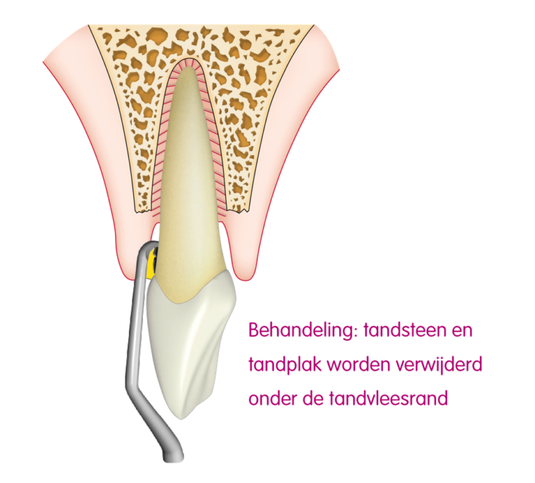 Tandvleesproblemen en mondhygiëniste - Tandartsengroepspraktijk Heemskerk