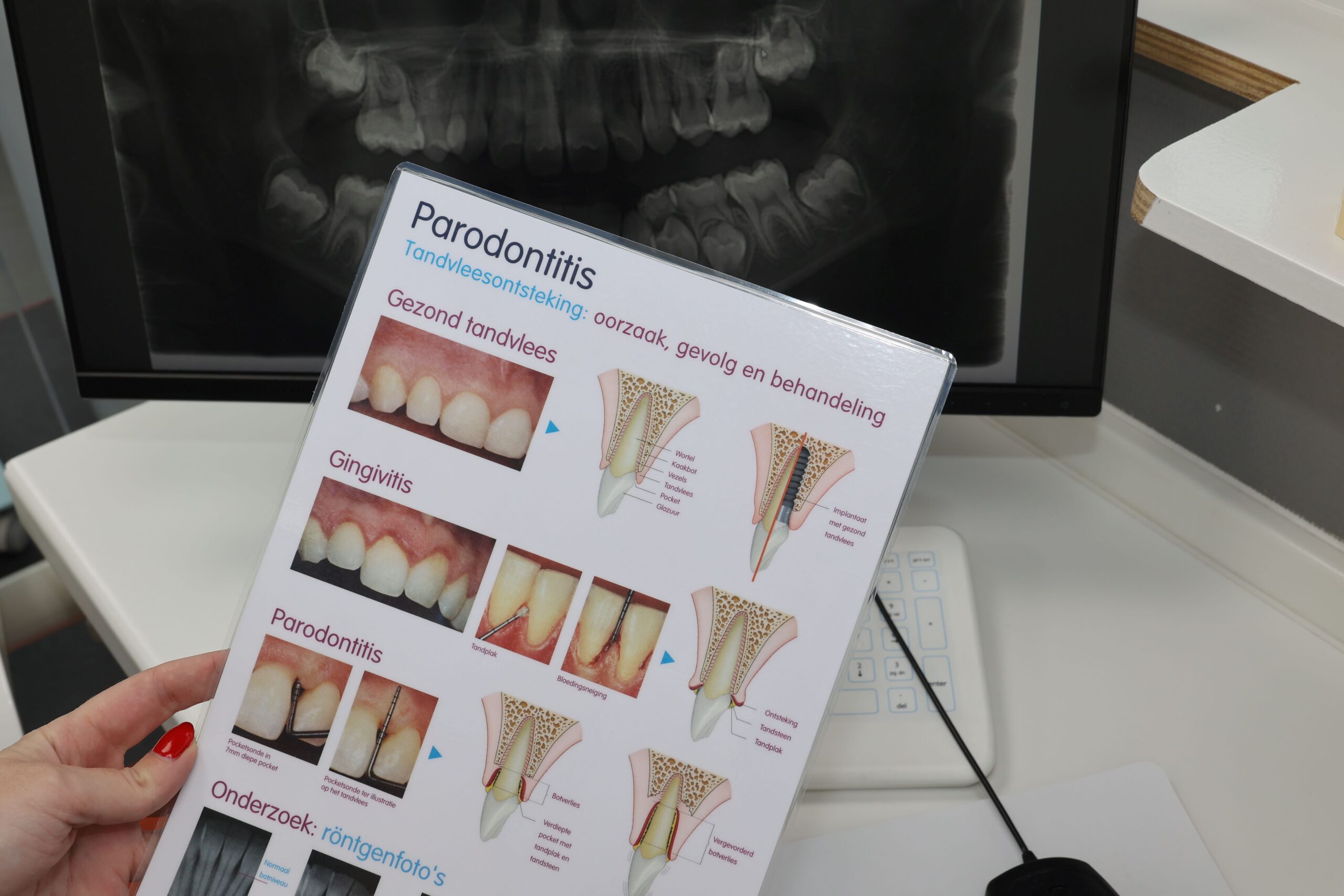 Tandvleesproblemen en mondhygiëniste - Tandartsengroepspraktijk Heemskerk